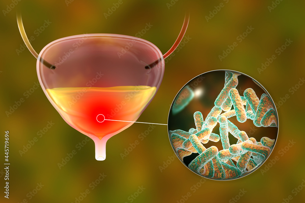 Cystitis, bacterial infection of urinary bladder Stock Illustration ...