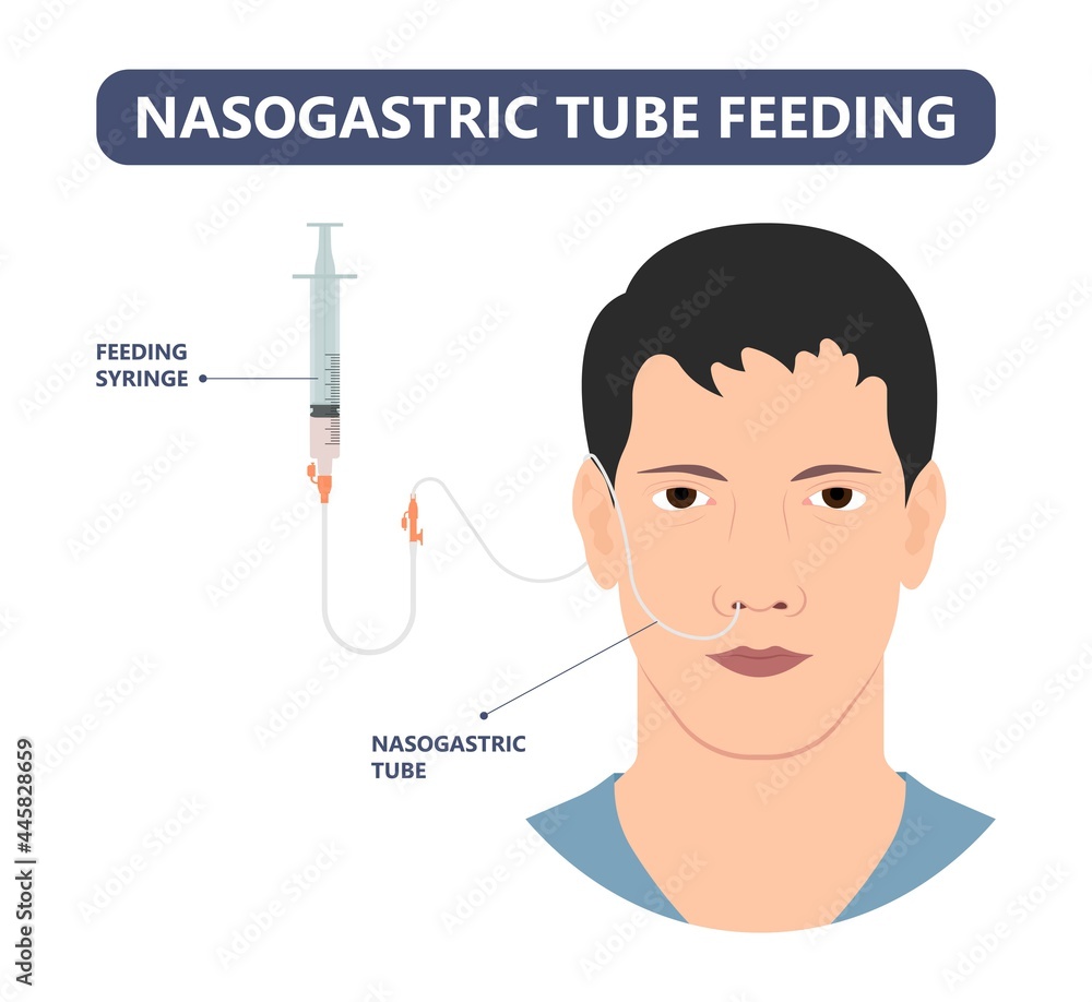 TPN PPN Total tube nutritional partial line PICC IV care unit ICU tract ...