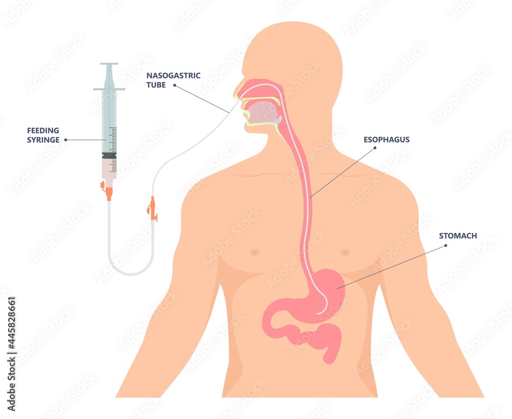 TPN PPN Total tube nutritional partial line PICC IV care unit ICU tract ...