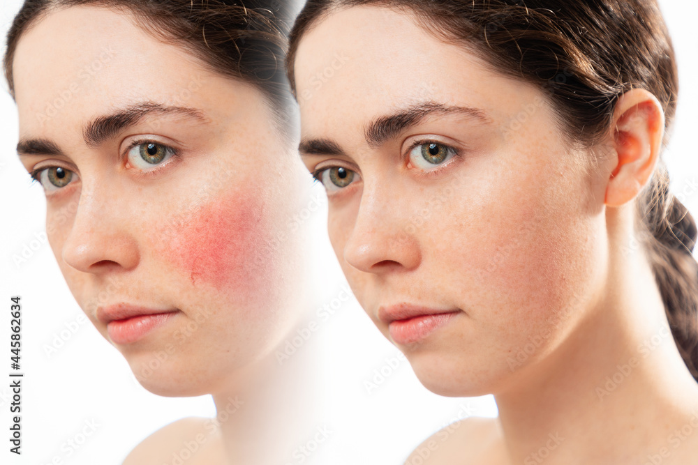 Couperose Vs Rosacea