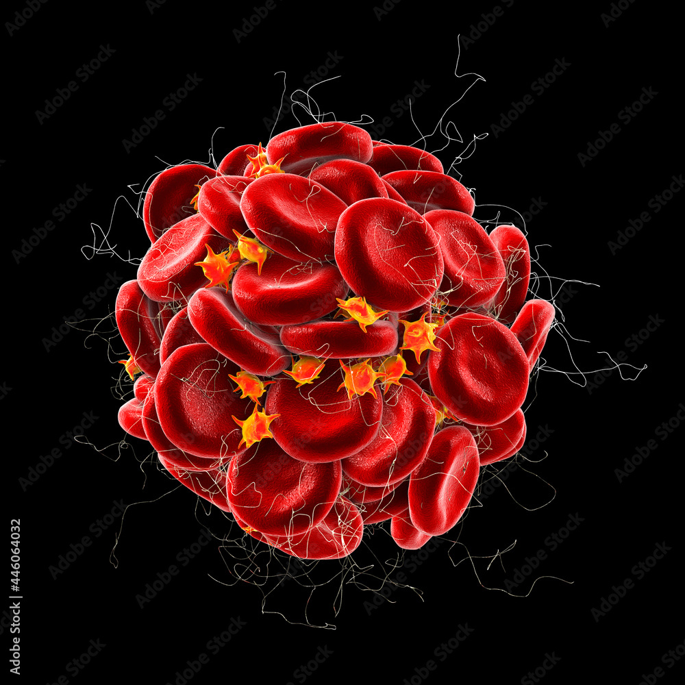 Blood clot made of red blood cells, platelets and fibrin protein ...
