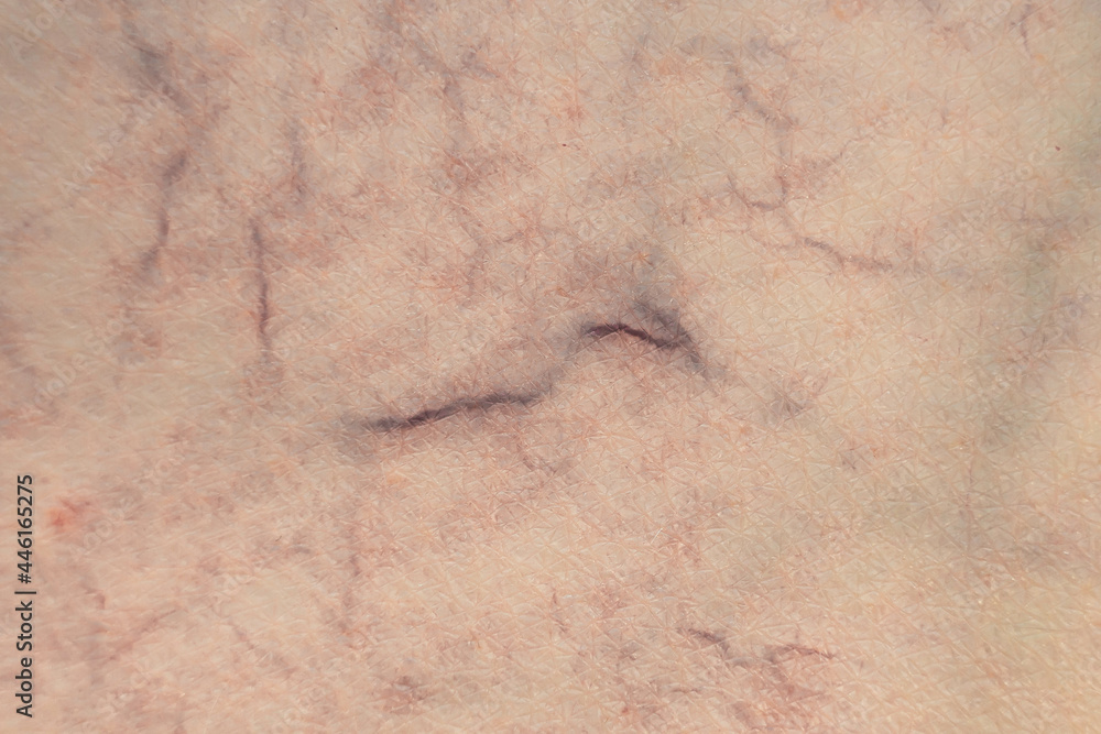 vein in the skin. a vessel is visible through the skin. ภาพถ่ายสต็อก ...