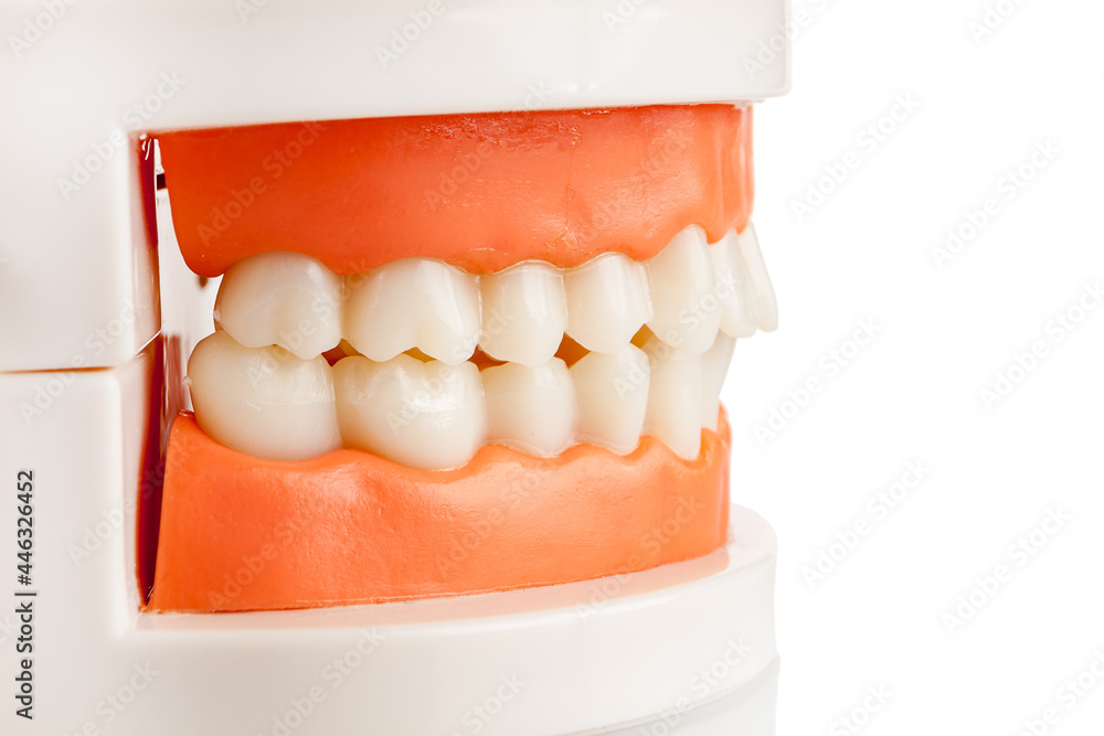 Orthognathic correct bite on the model of the jaws, orthodontic and ...