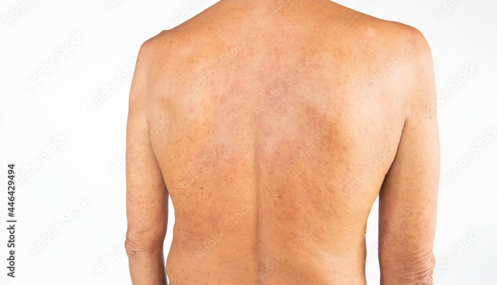 Skin rash on the back of the body from an allergic reaction in an ...