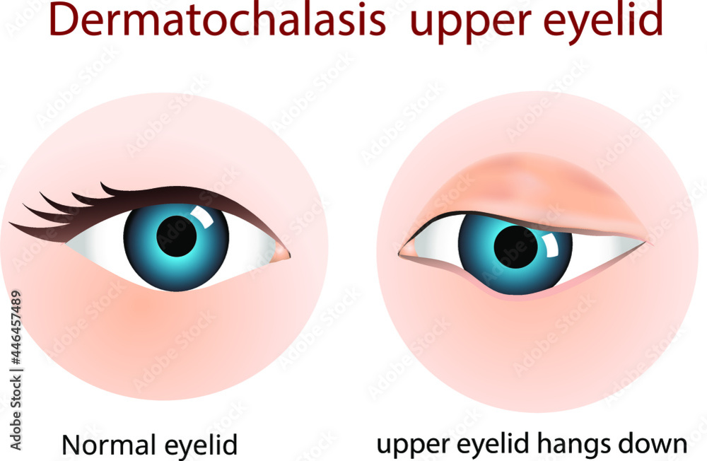 Dermatochalasis, Dermatochalasis is a term used to describe the ...