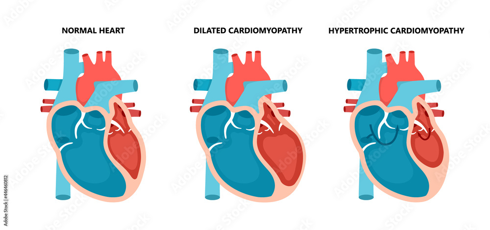 Types Of Heart Diseases Normal Hypertrophic And Dilated