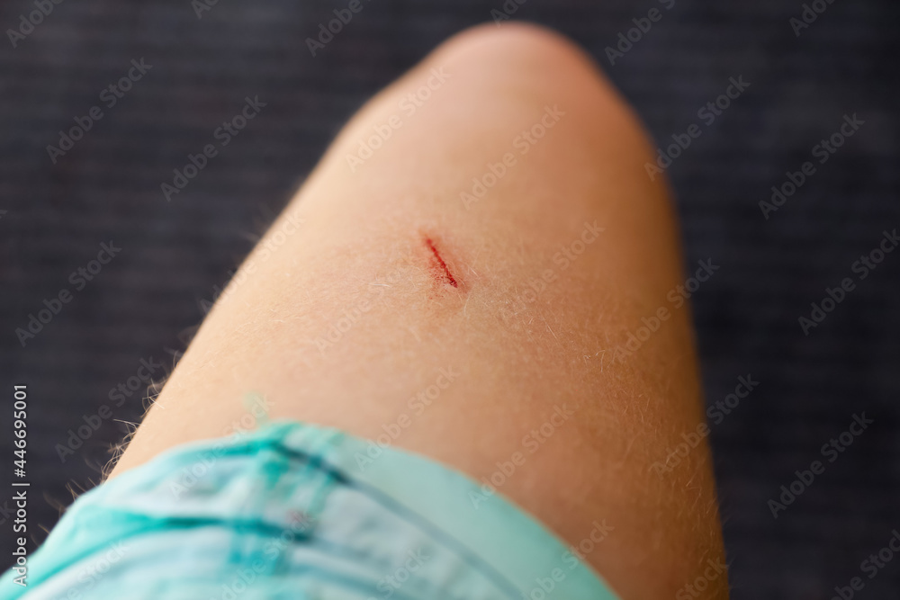 Fresh wound on the leg, thigh with blood. Skin texture. Body positive ...