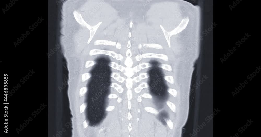 CT Chest or CT Scan of Lung Coronal MIP View for diagnosis TB,tuberculosis and coronavirus or ...