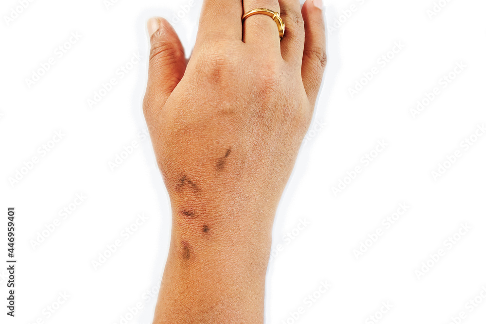 dry, dehydrated and cracked skin of asian women hand with black marks ...