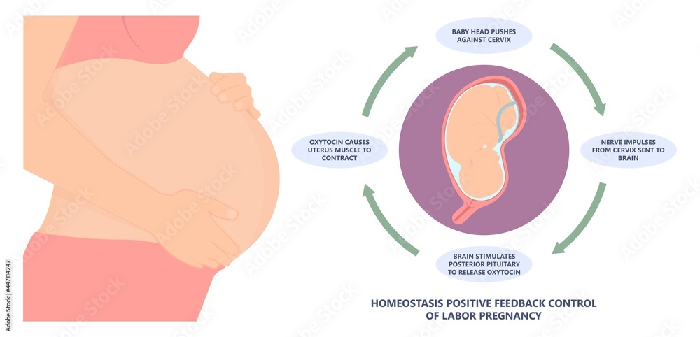 Vetor de Labor swept drug baby Foley Strip sweep sac uterus hook Amnio ...