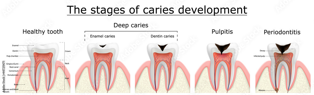 Stages of caries development. Dental disease: caries, pulpitis and ...