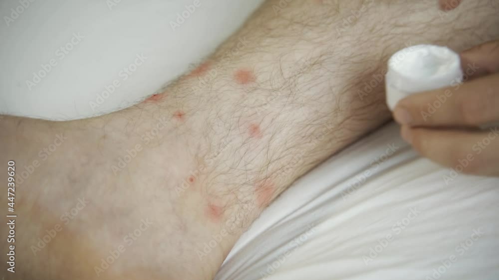 Application of therapeutic ointment for allergic rashes on the leg ...