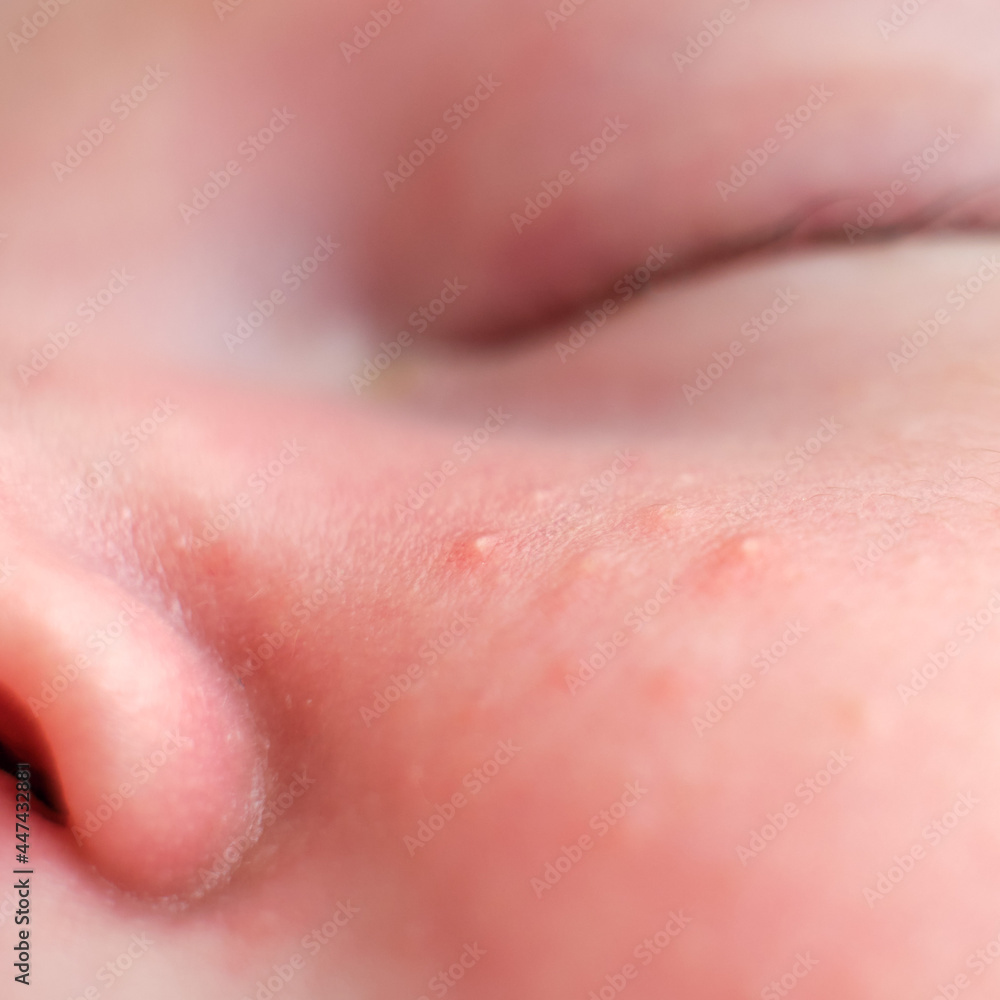 Acne on the face of a newborn child, close-up. Macro photos of skin ...