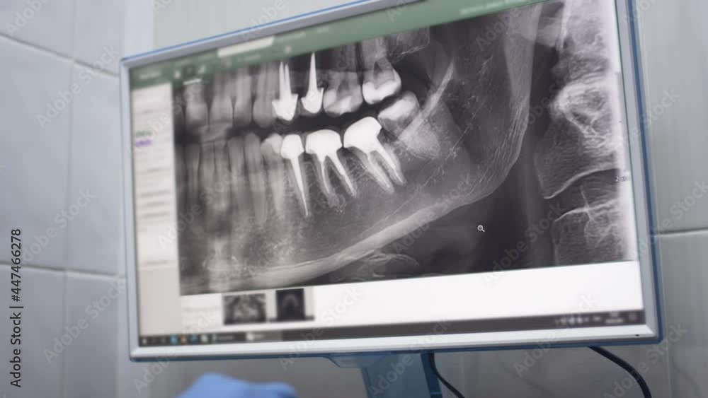 Stockvideo Dentist doctor examines a panoramic x-ray of the jaw on a ...