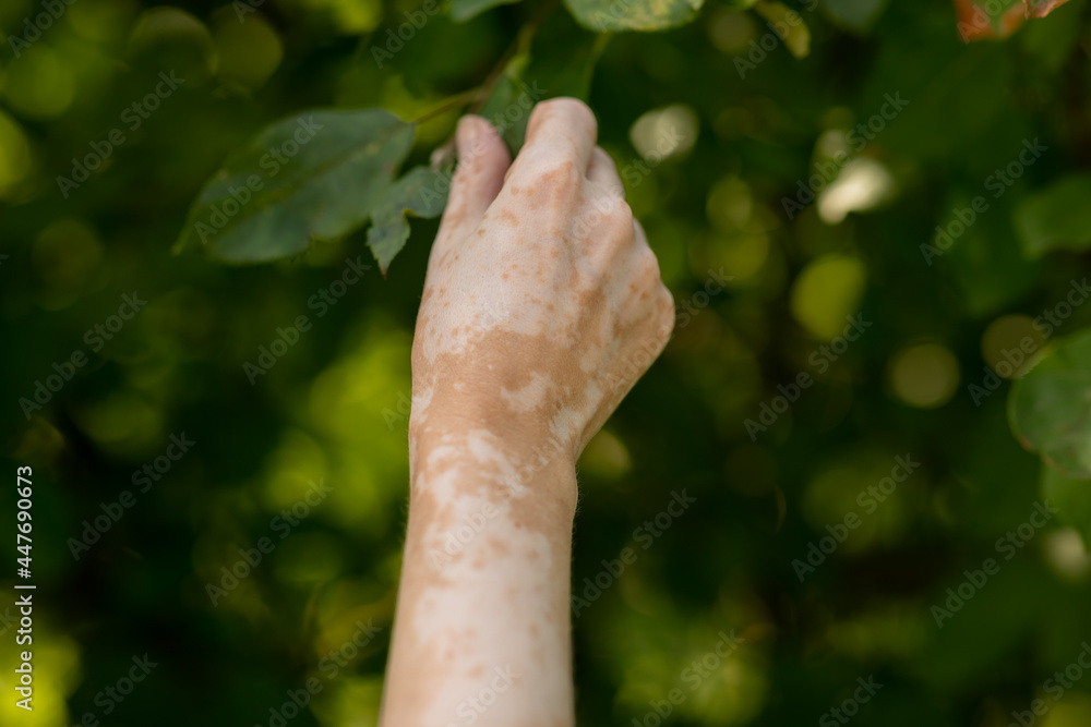 Hand skin pigmentation. White-brown leather. Melasma. Benign ...