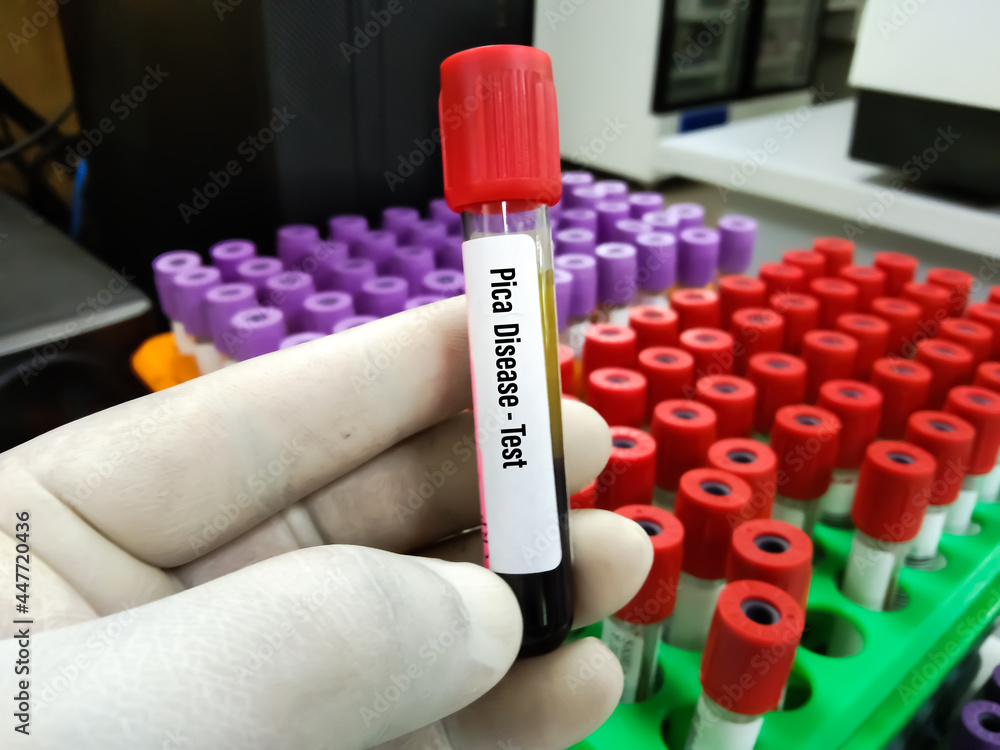 Doctor's hold blood sample tube for Pica Disease Test. Pica is a ...