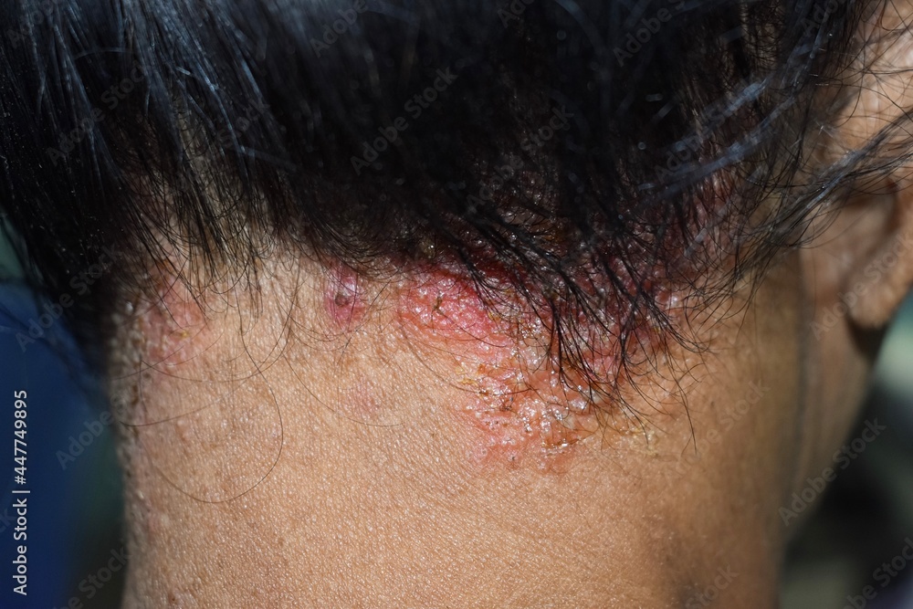 Fungal Skin Infections Back