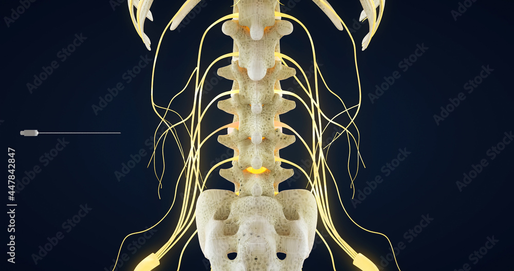 Protrusion of intervertebral discs, formation of a spinal hernia ...