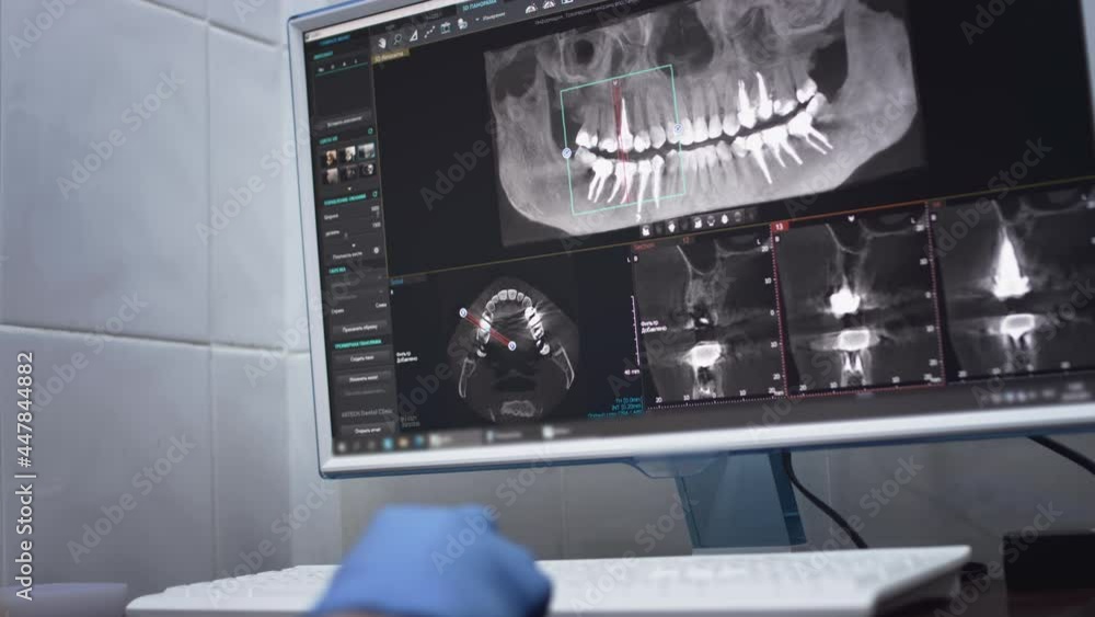 Dentist doctor examines a panoramic x-ray of the jaw on a computer ...