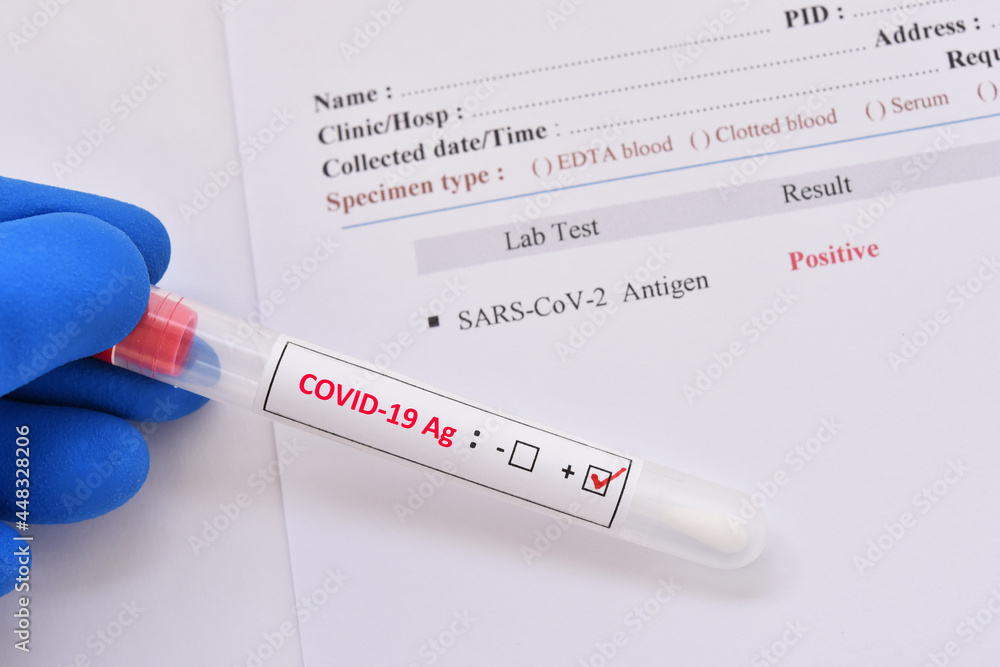 Nasopharyngeal swab positive with COVID-19 test by using antigen test ...
