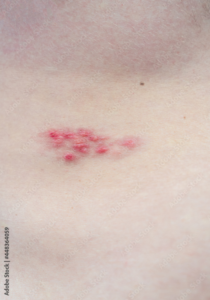 Abdomen of a man with Shingles or Herpes Zoster, a viral disease ...