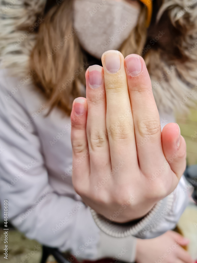 An attack of Raynaud's Syndrome or disease on a single finger showing ...
