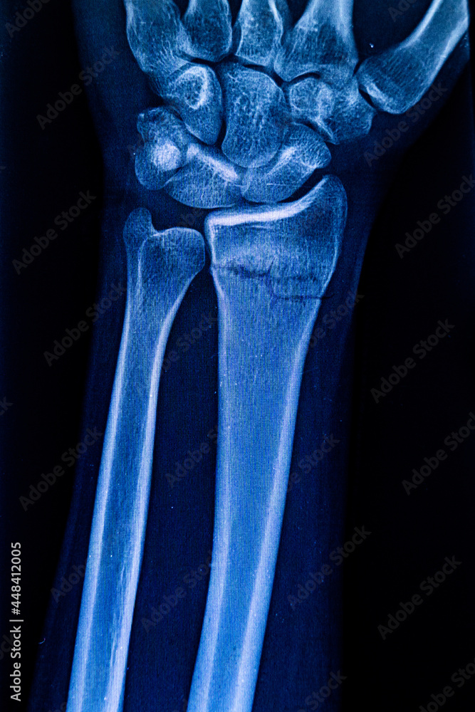 radiography examining x-ray film of patient's arm pointing to radius ...