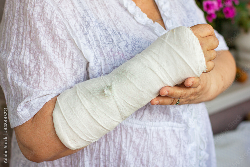 A cast was placed on the woman's broken arm for immobilization after ...