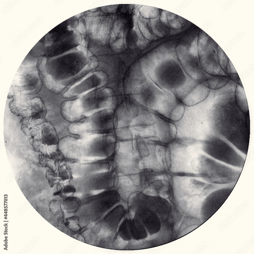 Barium enema image or x-ray image of large intestine or colon showing ...