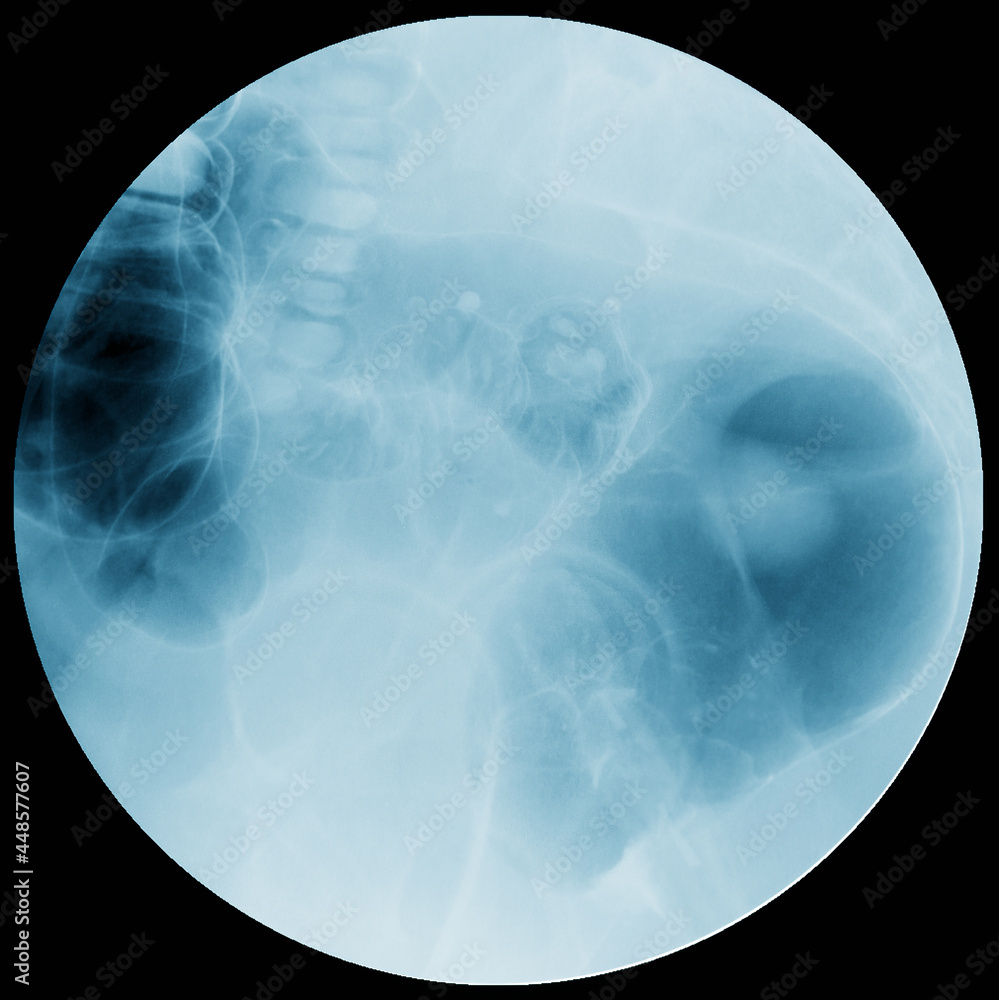 Barium enema image or colorectal x-ray view showing anatomical of large ...