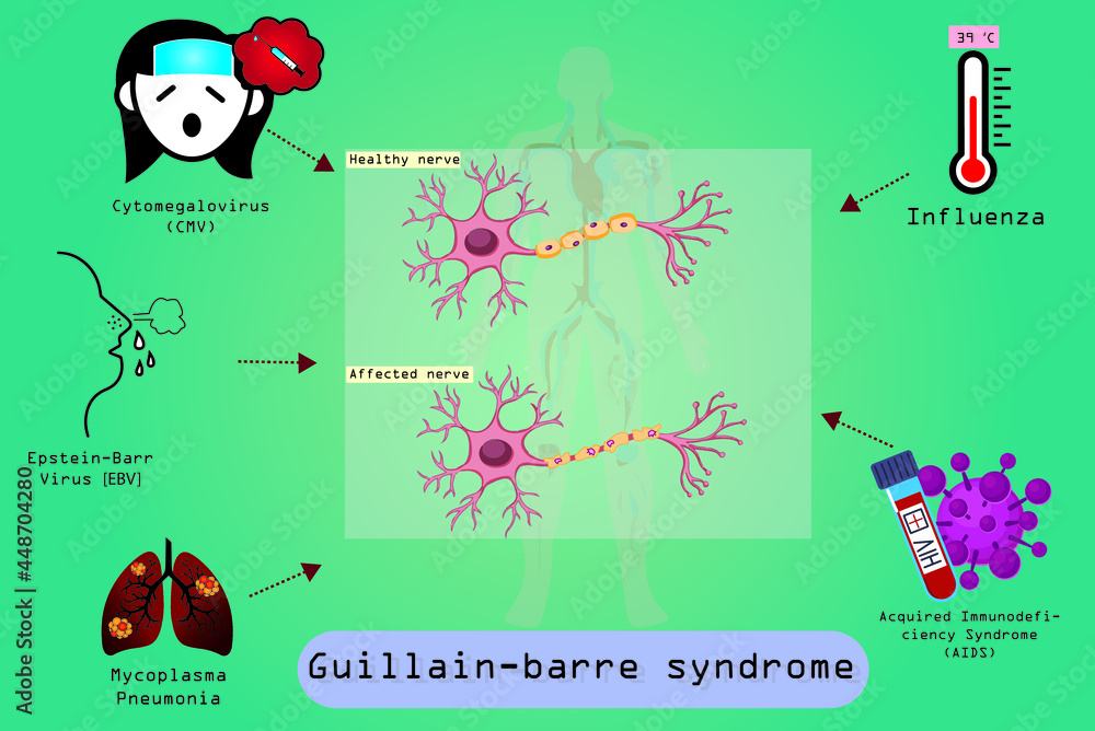 Guillain-Barre (gee-YAH-buh-RAY) syndrome is a rare disorder in which ...