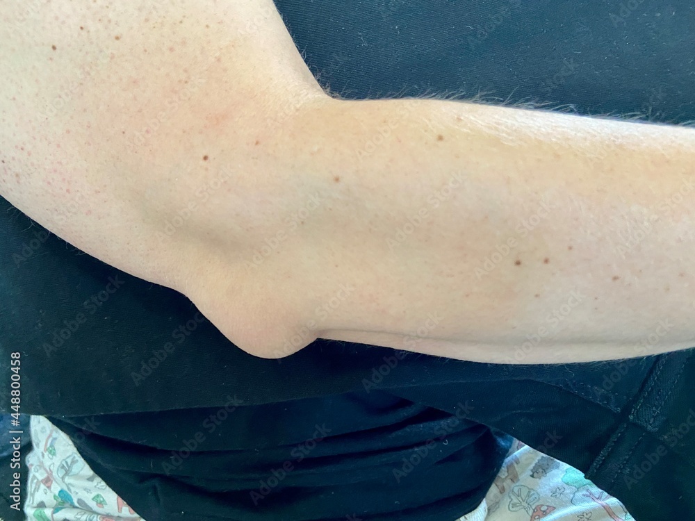 olecranon bursitis is sometimes called “Popeye’s elbow.” Bursitis is a ...