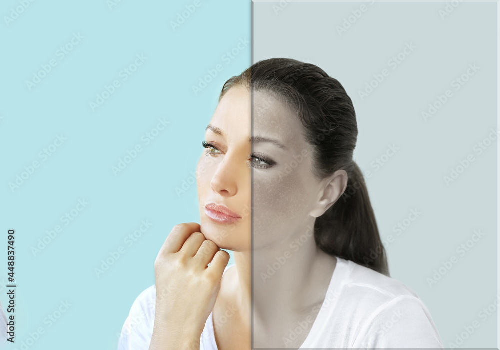 Dark spots, freckles,hyperpigmentation(melasma or chloasma),concept ...