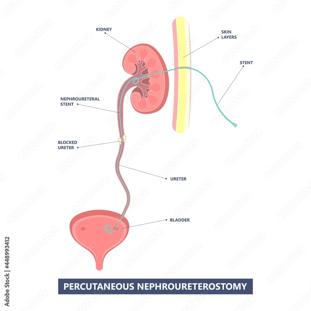 Tube Stent bag blocked kidney stone tumor urine urinary Drain renal ...