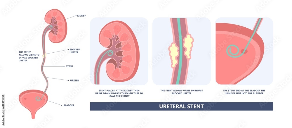 Tube Stent bag blocked kidney stone tumor urine urinary Drain renal ...