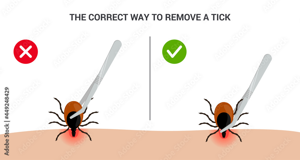 The correct way to remove a tick insect correctly. Tips for tick safety ...