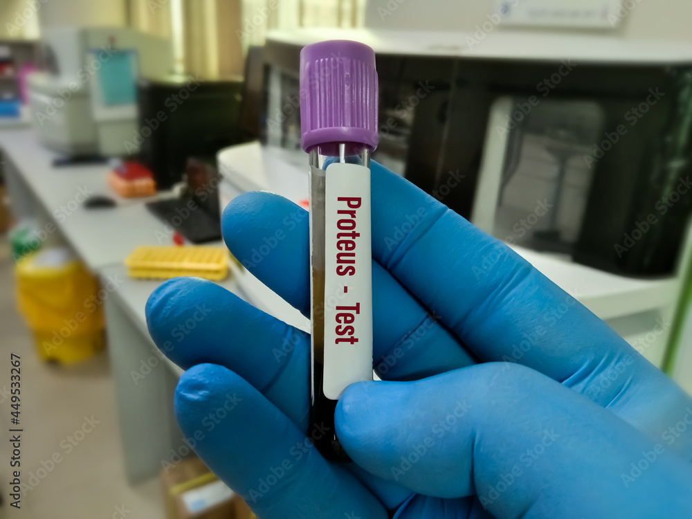 Blood sample tube for Proteus OX2, OX19 OXK antigen, Weil-Felix ...
