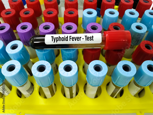 Blood sample tube for Typhoid and Paratyphoid Fever test at medical ...