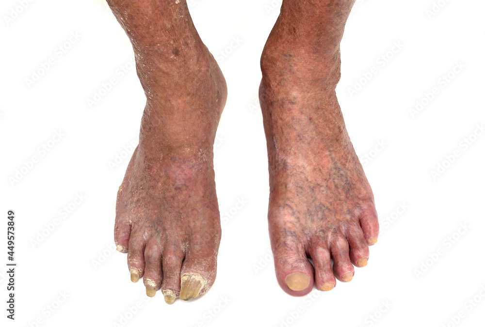 Feet of a very old man with long and damaged nails and dry skin before ...