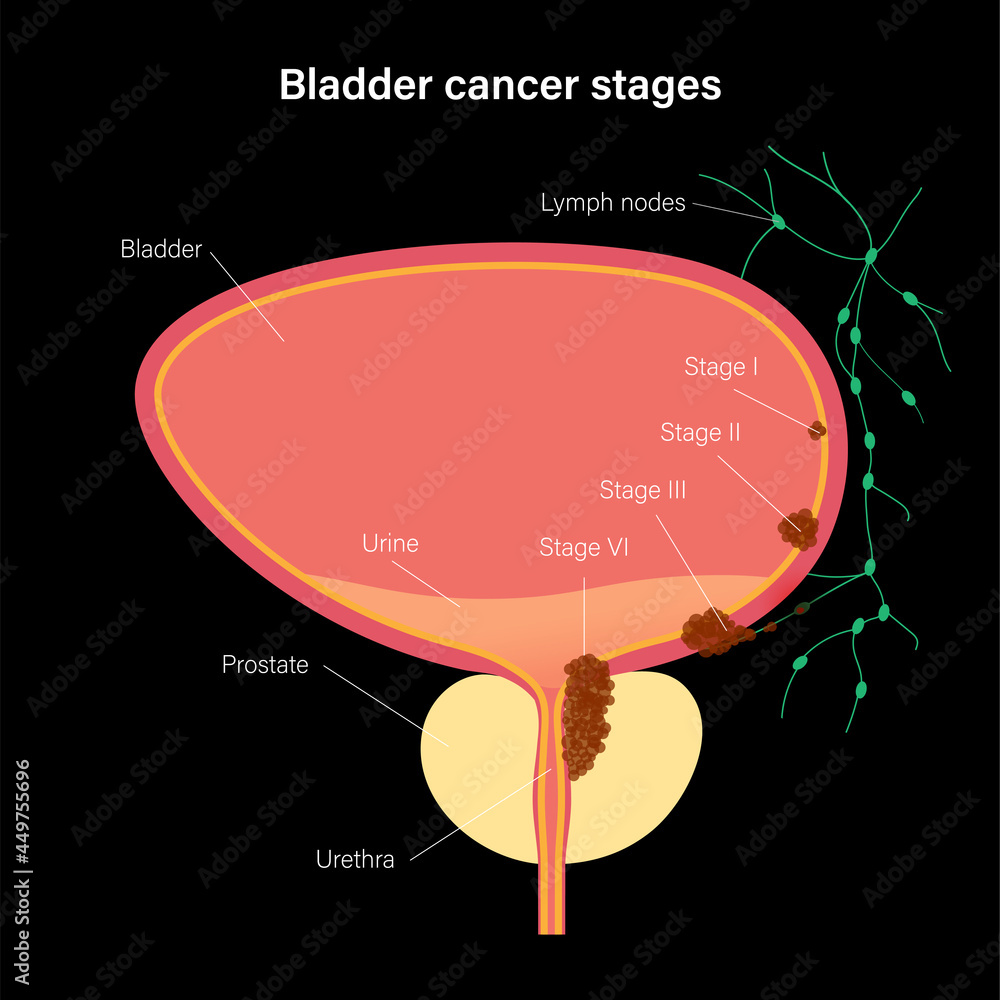 Bladder cancer stages Stock Vector | Adobe Stock