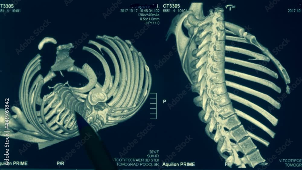 Magnetic resonance imaging (MRI) of the human chest with ribs, spine ...