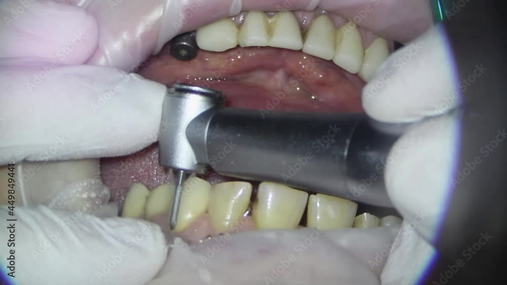 dentistry. shooting with a microscope. necrectomy. the dentist removes ...