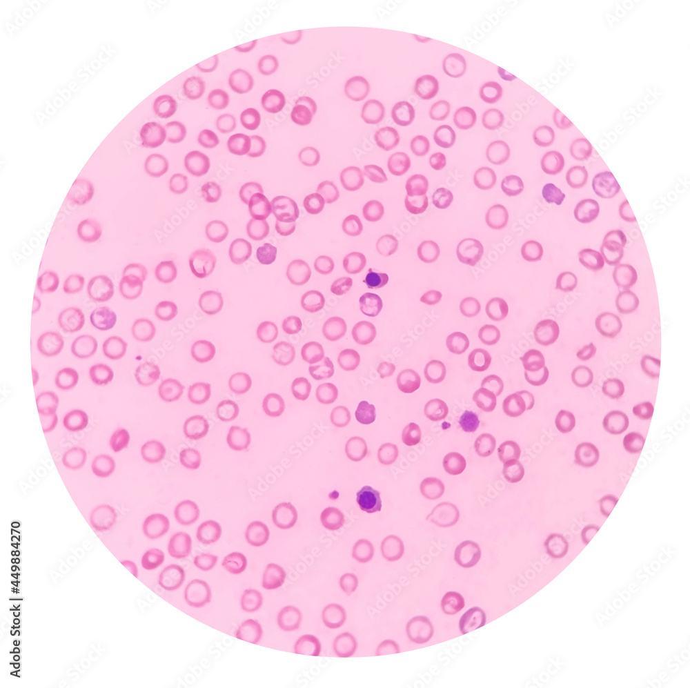 Under a microscope show the red blood cells have less color than normal ...