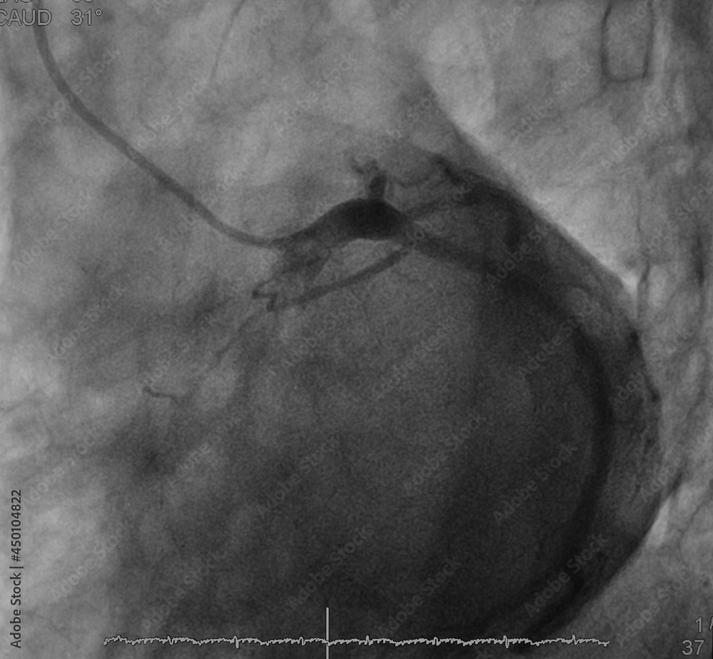 coronary angiogram (CAG) was showed chronic total occlusion (CTO) at ...