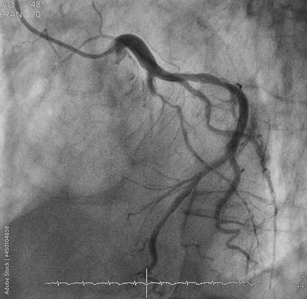 coronary angiogram (CAG) was showed chronic total occlusion (CTO) at ...