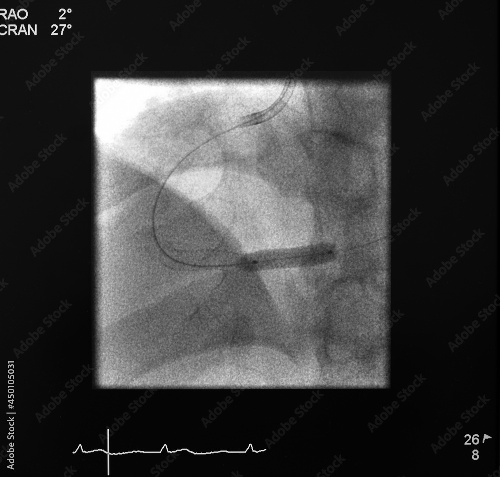 x ray image perform balloon catheter inflation at right coronary artery ...