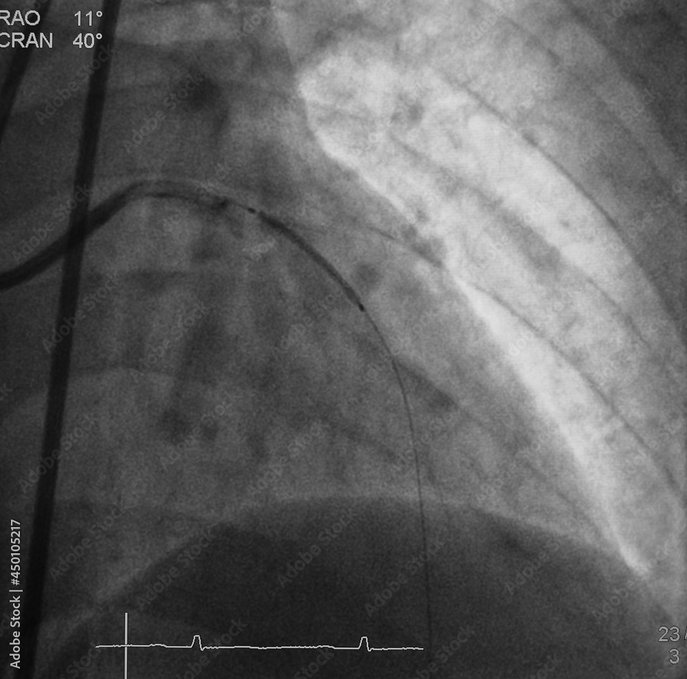 Foto Stock coronary angiogram (CAG) was performed percutaneous coronary ...