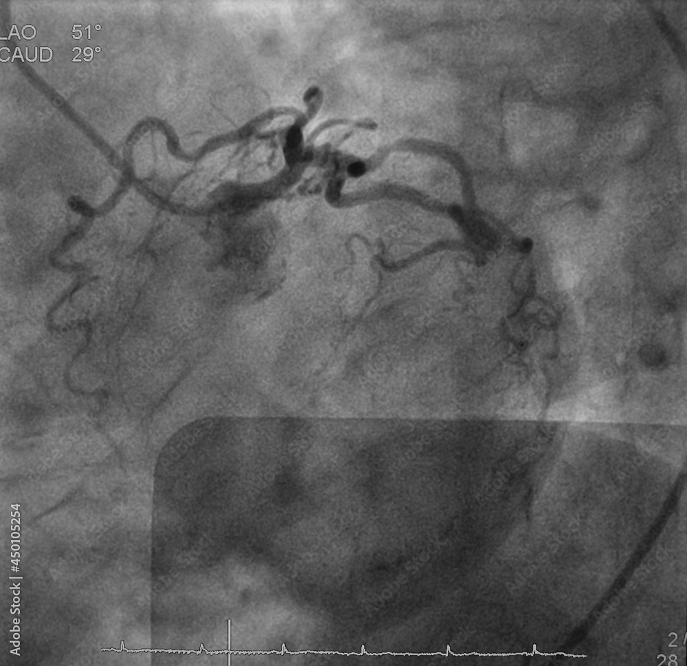 Coronary artery angiogram (CAG) of left coronary artery stenosis Stock ...