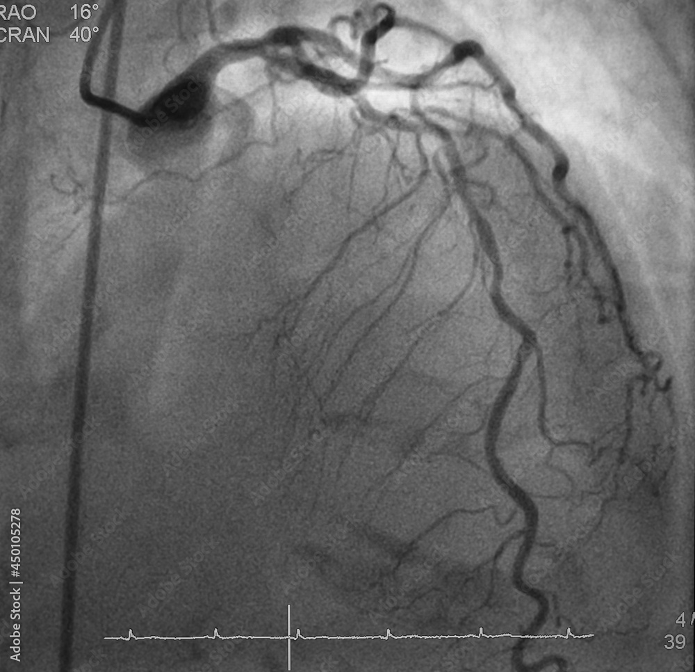 coronary angiogram (CAG) was showed left anterior descending artery ...