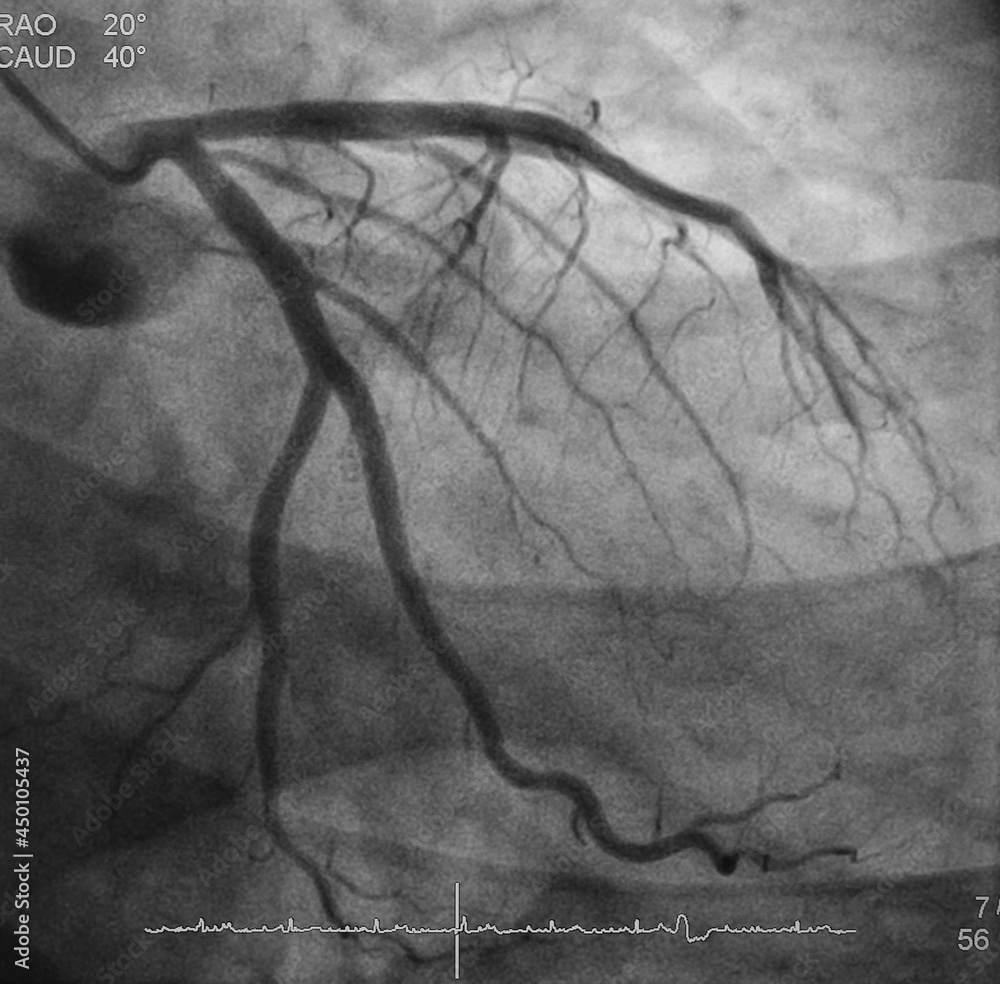 coronary angiogram (CAG) was performed normal left coronary artery (LCA ...